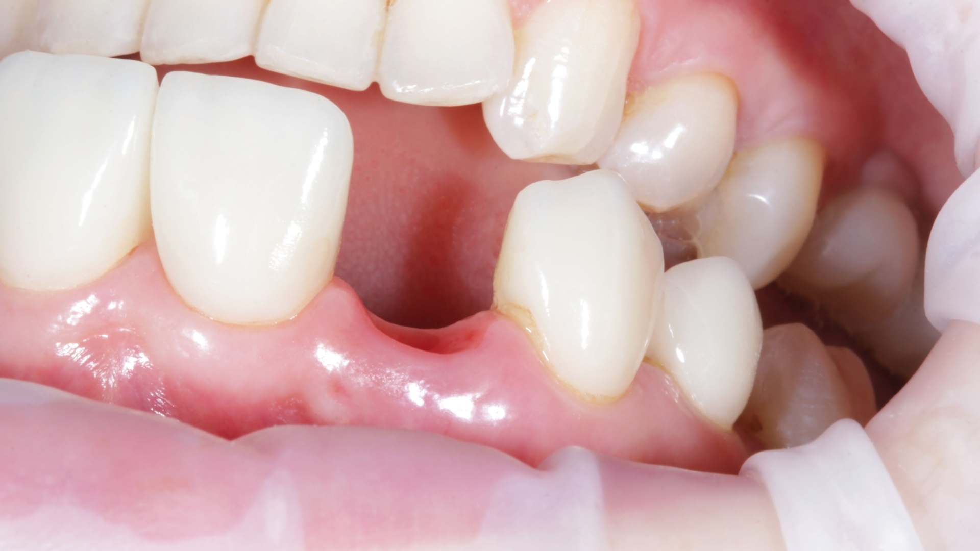 The Psychological Impact of Tooth Loss: How Missing Teeth Affect Mental ...